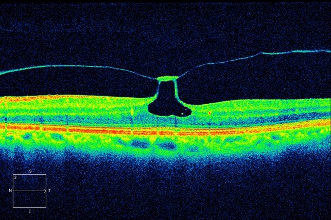 VMT, Vitreo Macular Traction Syndrome, SD OCT - Retina Image Bank VMT, Vitreo Macular Traction Syndrome, SD OCT - Retina Image Bank
